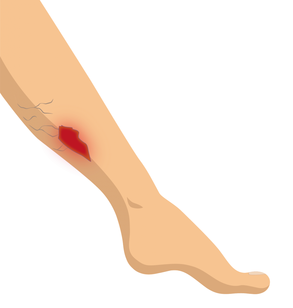 Leg ulcers - Urgo Medical tells you more about it